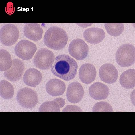 Basophilic Stippling Basophilic Stippling Of Erythrocytes In