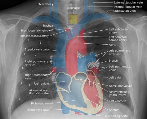 Mediastinal Structures On Chest X Ray Annotated Central Venous Catheter Wikipedia Medical