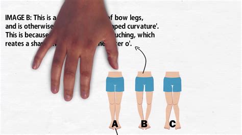 How To Correct Bow Legs Without Surgery Youtube Youtube