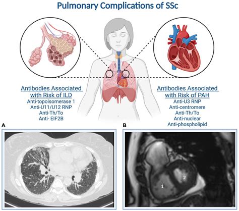 Systemic Sclerosis Auto Antibodies Associated With The Development Of Download Scientific