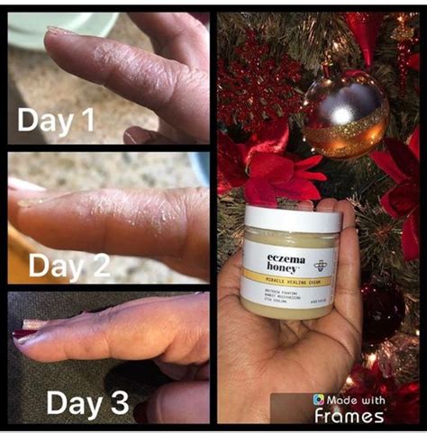 3 Ways To Treat Hand Eczema Artofit