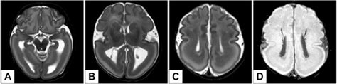 Lissencephaly Ultrasound
