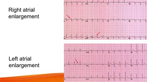 Basics Of Ecg Ppt