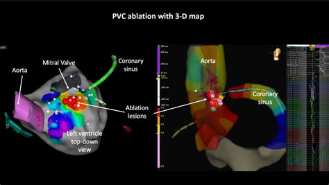 Premature Ventricular Tachycardia Pvc Dr Hari Sugumar