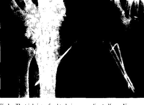 Distal Radius Fracture Kapandji Intrafocal Pinning Technique