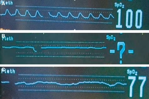 A Normal Pulse Wave And Spo2 Maintained At 100 Before Aortic