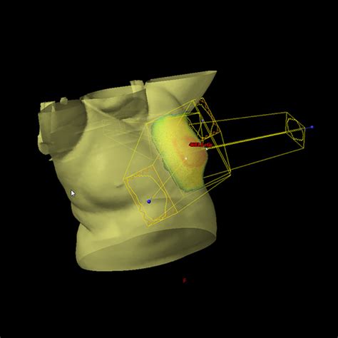 3d Radioterapia Tridimensional Conformada Mevaterapia Oncología