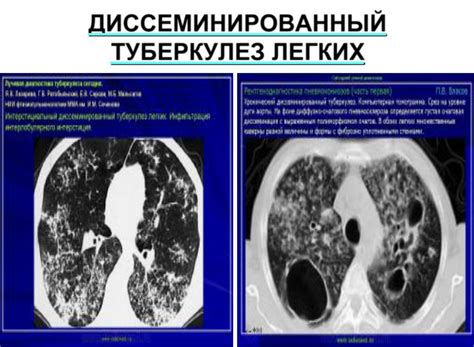 ДИССЕМИНИРОВАННЫЙ ТУБЕРКУЛЕЗ ЛЕГКИХ