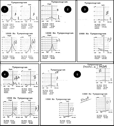 High Frequency Tympanometry 1000hz In Young Infants And Its Comparison With Otoacoustic