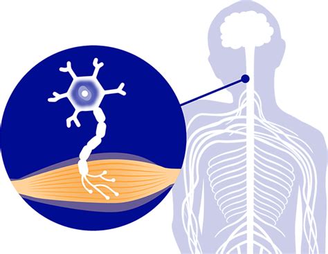 Amyotrophic Lateral Sclerosis Als Treatment In Delhi