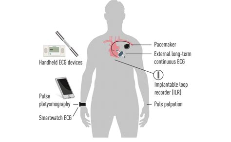 Examples Of Methods And Devices Used For Atrial Fibrillation Screening Download Scientific