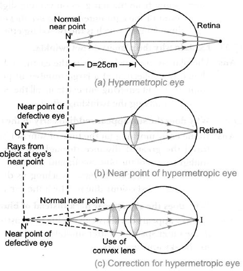 Make A Diagram To Show How Hypermetropia Is Corrected The Near Point