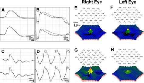 Full Field Electroretinogram Waveforms Obtained 3 Months After The Download Scientific Diagram