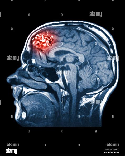 Blutgefäß Tumor Farbige Magnetresonanztomographie MRT head Scan