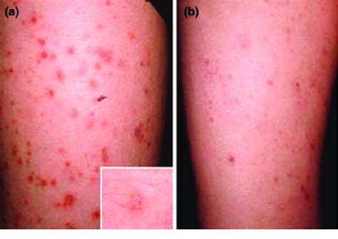 Macules Vs Papules