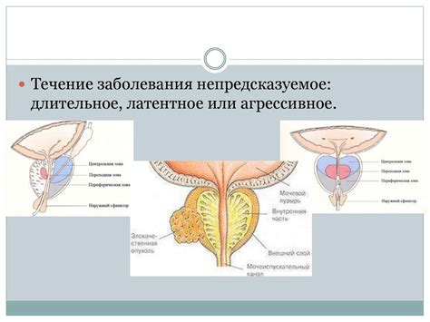 Диагностика рака предстательной железы презентация онлайн