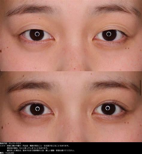 二重整形に失敗した場合の対処法・失敗例とは？やり直し方や、失敗の原因を二重切開法・埋没法に分けて医師が解説│select Clinic Tips