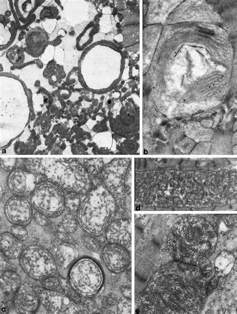 Electron Micrographs Showing Characteristic Ultrastructural Changes Of