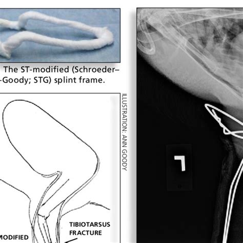 Post Operative Radiograph Of Stg Modified Splint And Intramedullary Pin