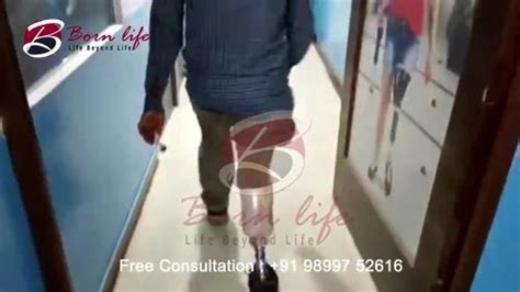 Artificial Leg Below Knee At Best Price In New Delhi By Bornlife