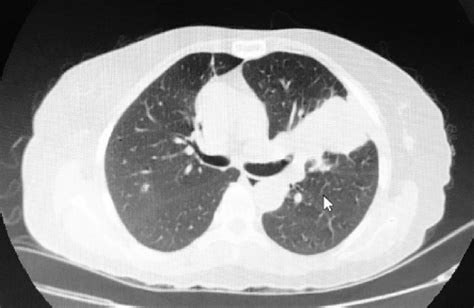 Computed Tomography Scan Showing 34 Cm × 32 Cm Mass In The Lingular