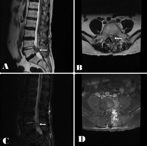 Mri Scans Showing Contrast Enhanced Mass Mri Magnetic Resonance