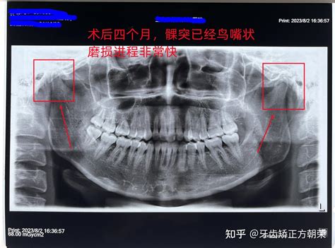 颞下颌关节保守治疗能让髁状突长回去吗？ 知乎