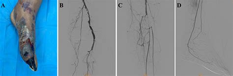 Postoperative Pyoderma Gangrenosum In Artery Disease Ccid