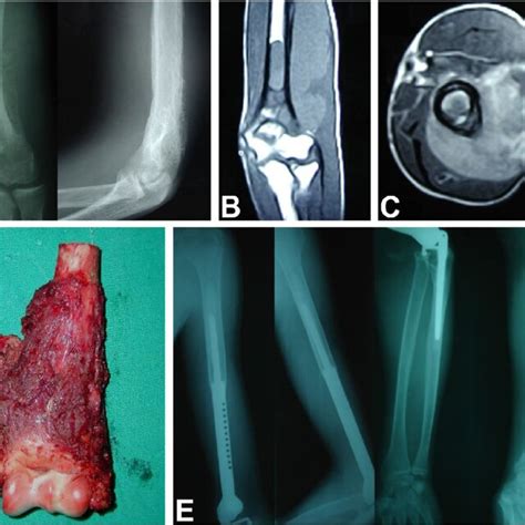 A 19 Year Old Male Patient With Ewings Sarcoma Of The Distal Humerus