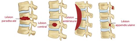 Tuberculosis Of The Spine Osteomag