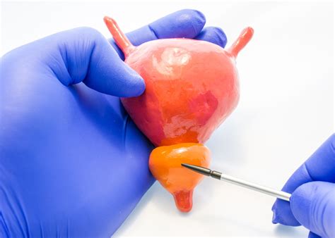 Próstata inflamada como prevenir e atenuar os sintomas