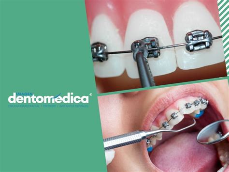 EL MEJOR CIRUJANO MAXILOFACIAL EN LEÓN GUANAJUATO Los brackets y el