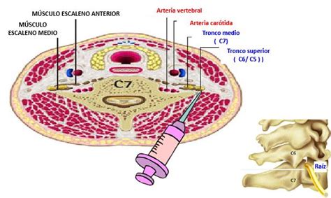 Bloqueo Paravertebral Cervical Dolopedia