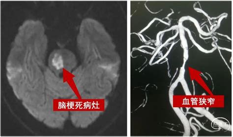 宣武医院吴川杰：哪些脑血管狭窄需要放支架？ 脑医汇