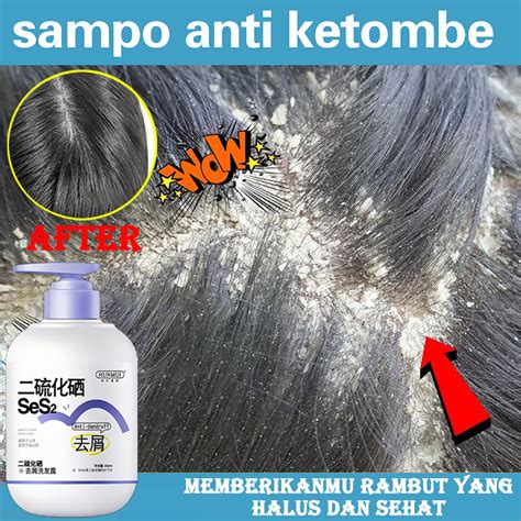 Jual Shampo Anti Ketombe Selenium Sulfide Atasi Ketombe Parah And Gatal