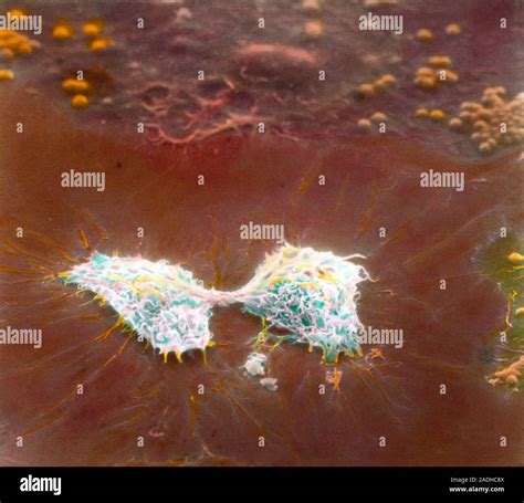 Lung Cancer Cells Coloured Scanning Electron Micrograph SEM Of Two Lung Cancer Cells Forming