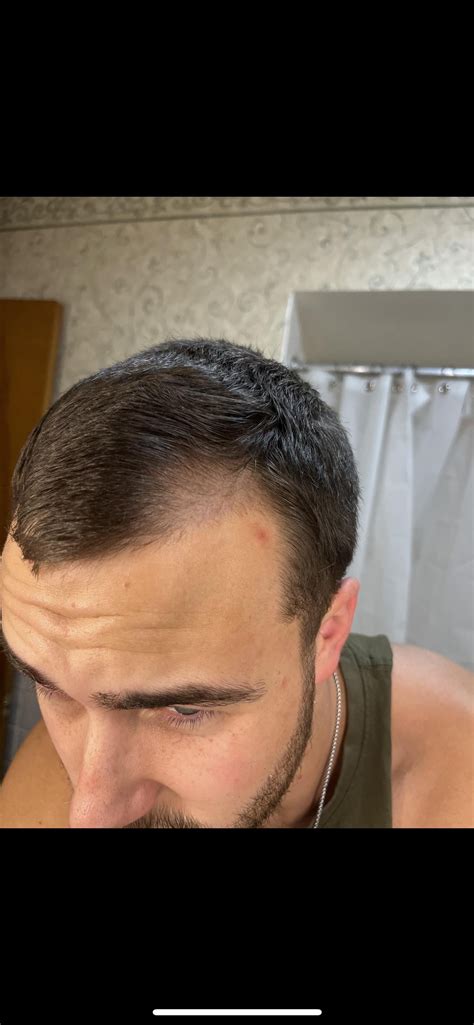 Hair Thinning Hair Loss At 18 Rhairloss