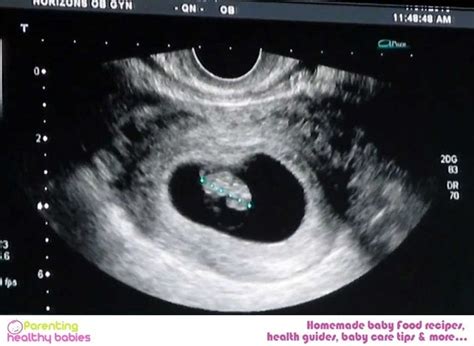 3 Weeks Pregnant Ultrasound 10 Week Ultrasound Pictures 2 Months