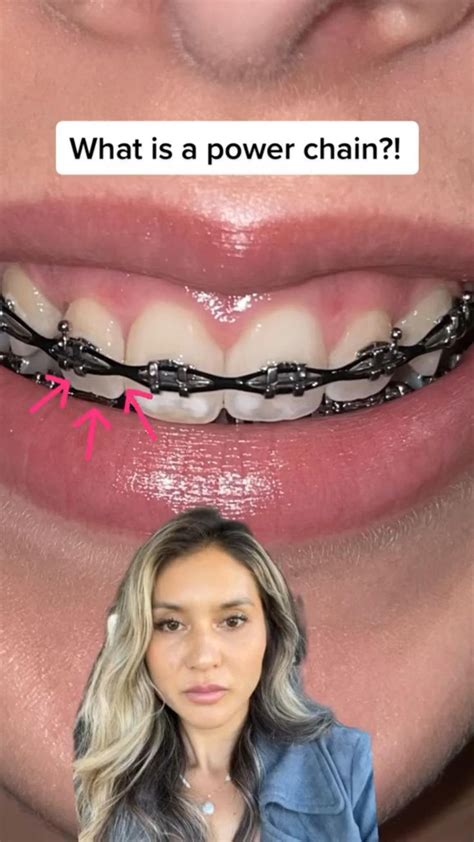 What Is A Power Chain Braces Braceson Braces Colors Cute Braces