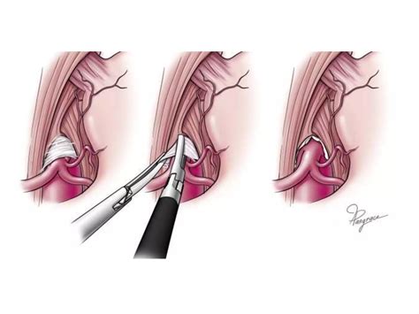 Management Of Mesenteric Vascular Occlusion Ppt