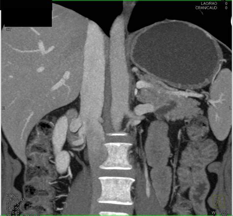 Side Branch Intraductal Papillary Mucinous Neoplasm Ipmn In The Tail