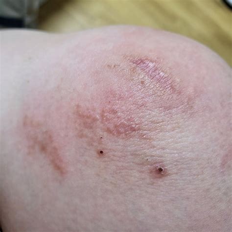 피부가 가려워서 미치겠어요 병원다녀와도 소용이 없눈듯합니다 피부전문의 답변 구해요 지식in