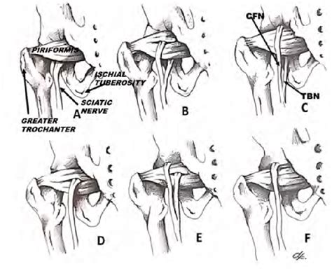 Figure 3 From The Importance Of Learning Anatomical Variation In Dissection Anatomy Sciatic