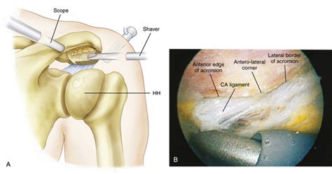 Subacromial Decompression Recovery Timeline What To Expect After Surgery