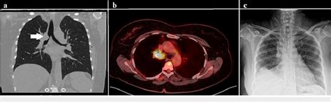The Chest Ct Showing A Mass In The Right Upper Lobe Bronchus Extending