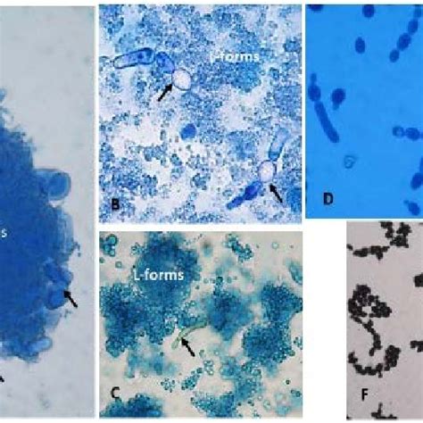 Transformation Of L Forms Into Classical Bacteria In Broth Patient 1