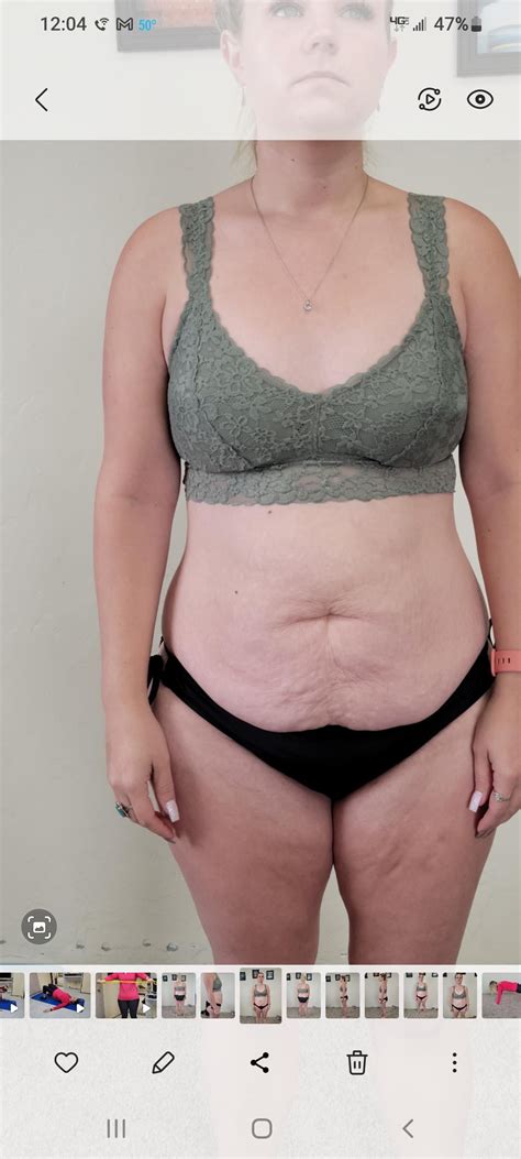 2 Weeks Post Op Tummy Tuck With Mr Rtummytucksurgery