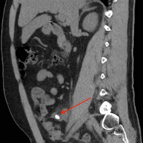 Sagittal CT Image Of The Abdomen And Pelvis Without Contrast Sagittal Download Scientific