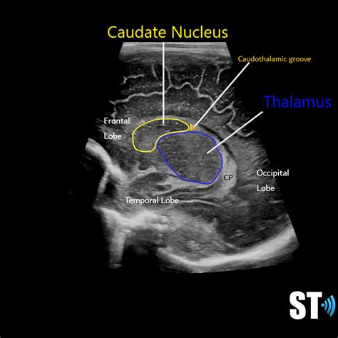 Neonatal Neurosonography Sonographic Tendencies