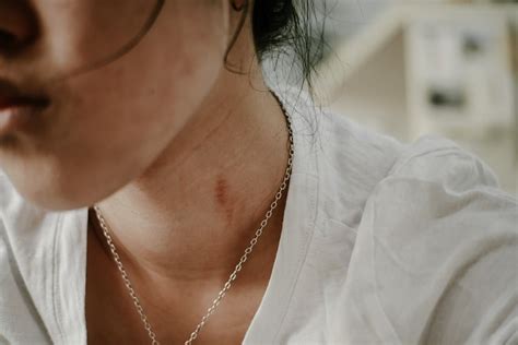 How To Cover Hickey In 8 Easy Steps Mom Curls